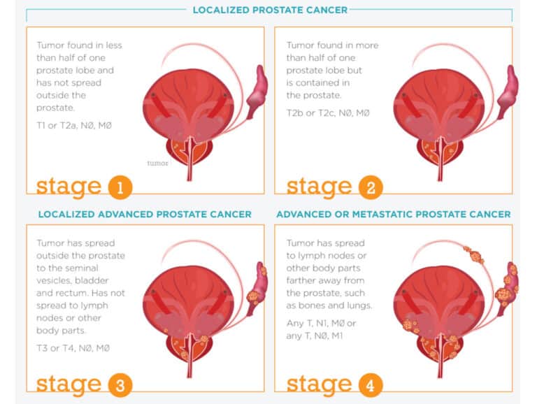 Interpret My PSA | Interactive PSA Interpretation Tool for Prostate Health
